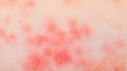 Ekzeme behandeln und vorbeugen | Liebenswert Magazin